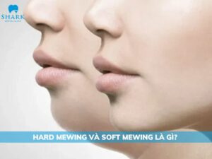 Hard Mewing và Soft Mewing là gì? Cách tập đúng chuẩn nhất